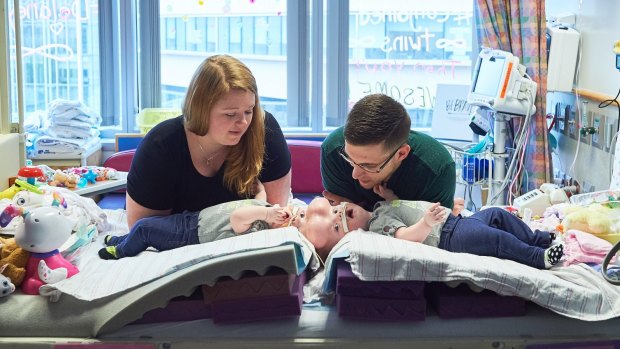 Doctors just separated twin girls joined at the head in one of the ...