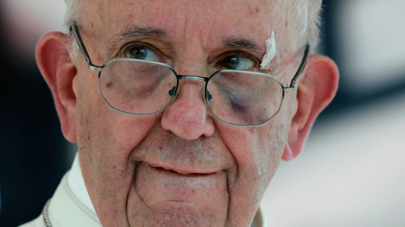 Pope Francis suffers black eye from popemobile