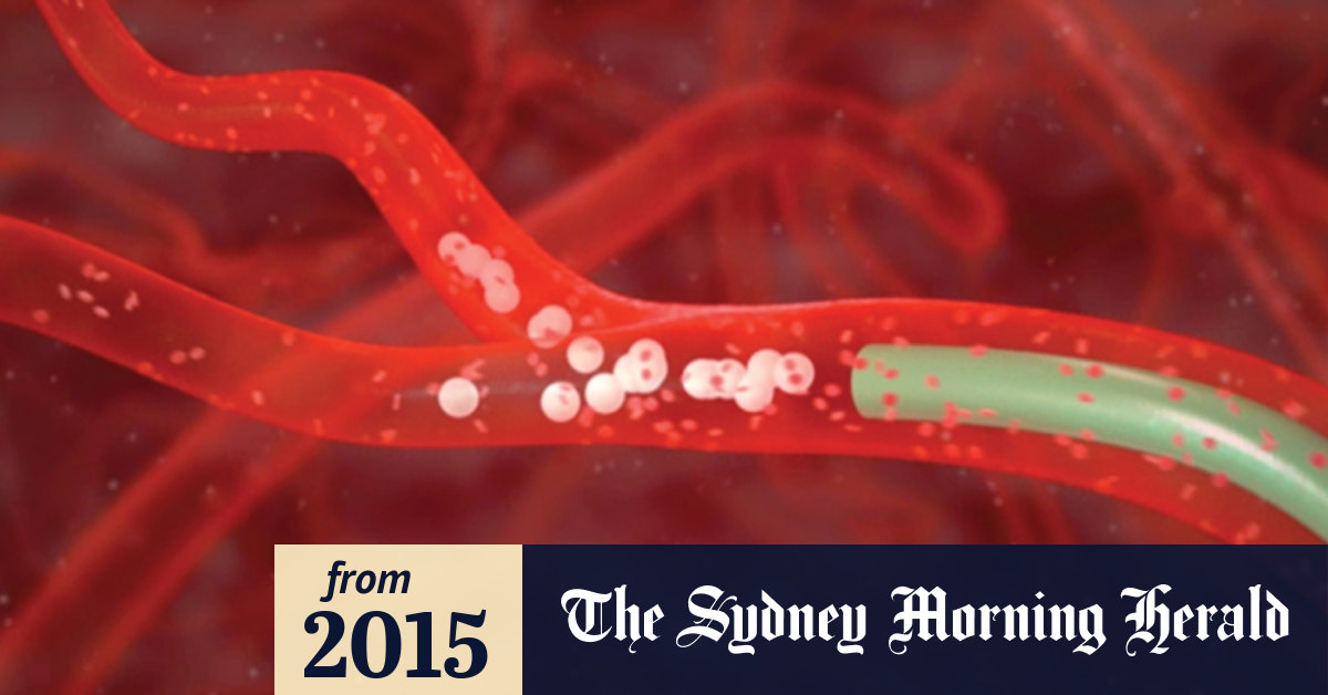 Radioactive 'bullets' offer a shot at beating bowel cancer