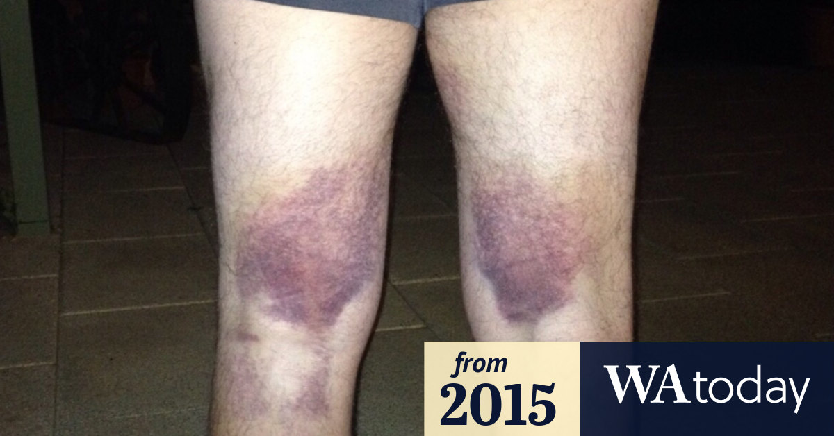 Pulled Hamstring Bruise