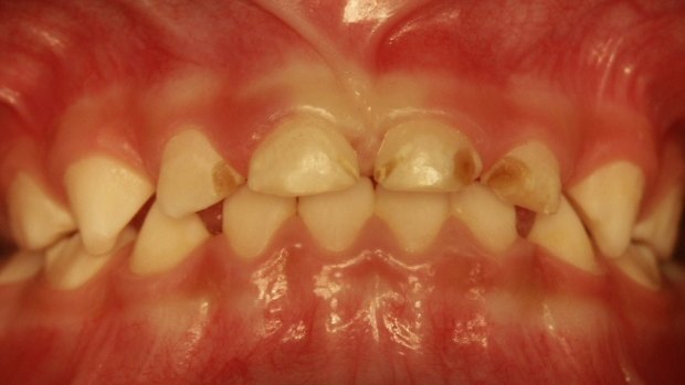 'Things just exploded in his mouth': kids' tooth decay unnoticed in Perth