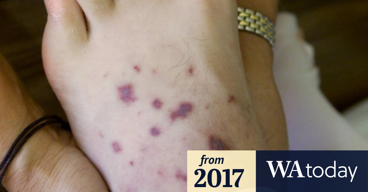 Two new cases of meningococcal disease in WA