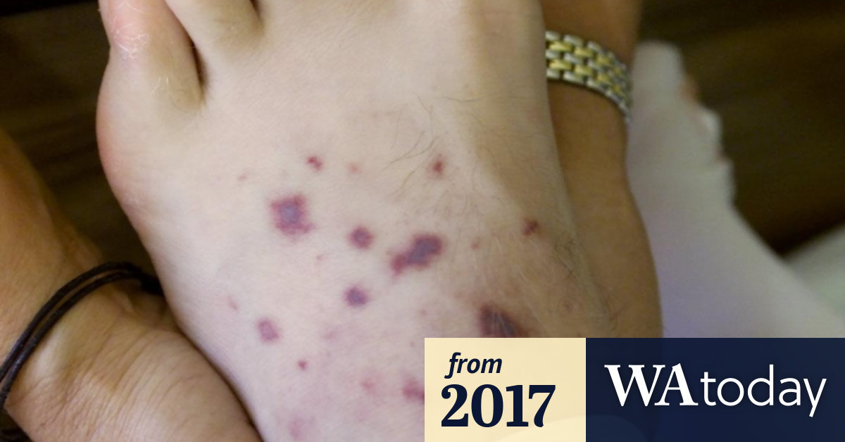 Two new cases of meningococcal disease in WA