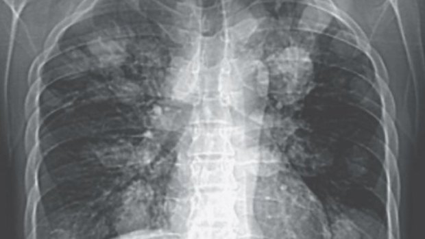 Concerns lung cancer screening for smokers may do more harm than good