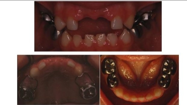'Things just exploded in his mouth': kids' tooth decay unnoticed in Perth