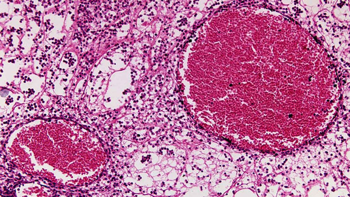 South Australia meningococcal death: Man dies after catching disease ...