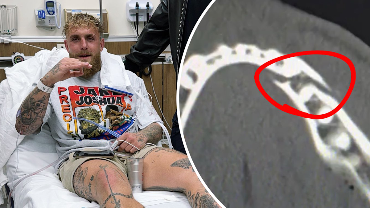 Boxing news 2025: Jake Paul reveals broken jaw X-ray after knockout ...