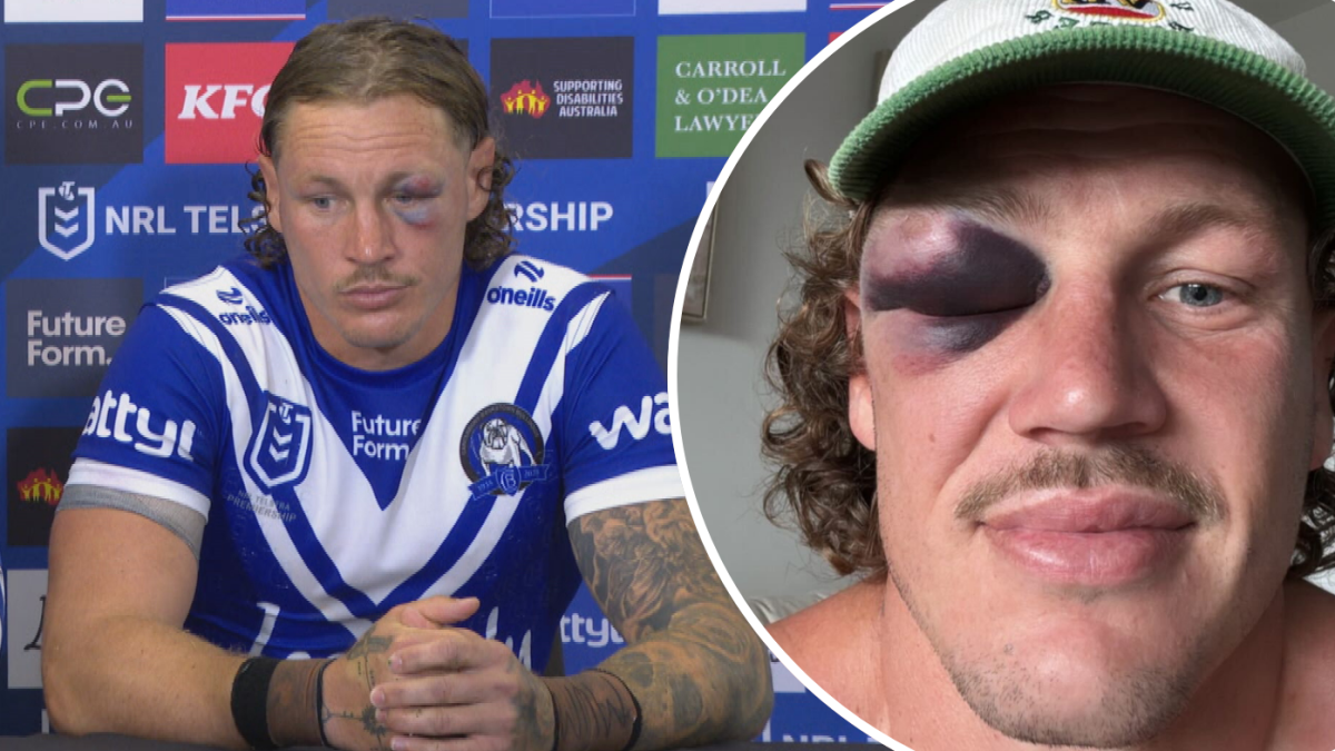 NRL news 2025: Canterbury Bulldogs lock Kurt Mann picture of brutal eye ...