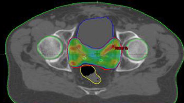 Australian men more likely to die from prostate cancer than Americans