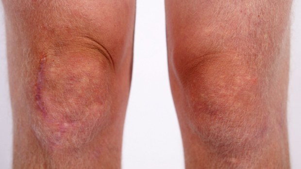 Is arthroscopy a dicky procedure for a dicky knee?