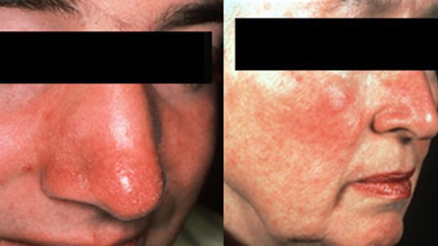 Study links Alzheimer's to the skin disease rosacea