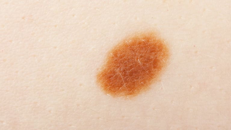 Common lumps and bumps on and under the skin: what are they?
