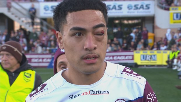 NRL news 2024: Manly Sea Eagles, Lehi Hopoate eye socket injury, sidelined