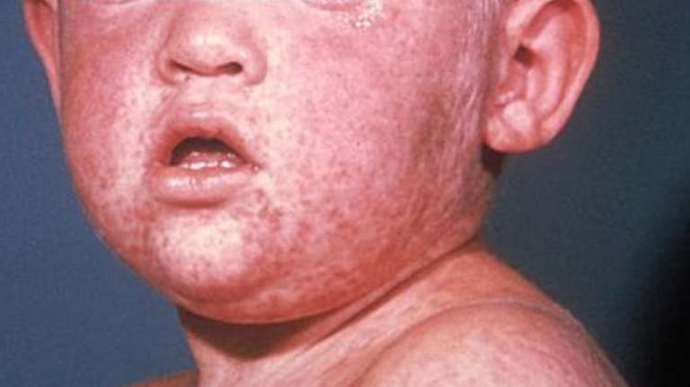 Measles alert: four people with measles have been in planes, surgeries ...