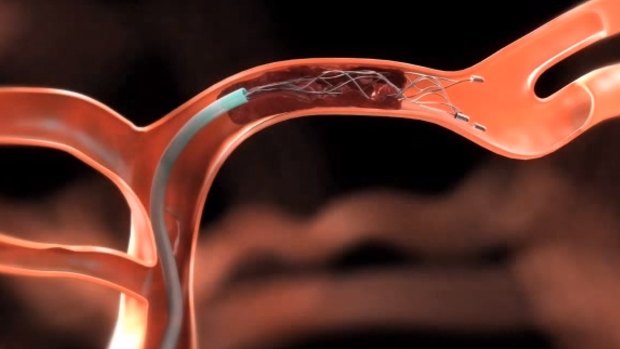 Lives could be saved with access to clot-buster device: expert