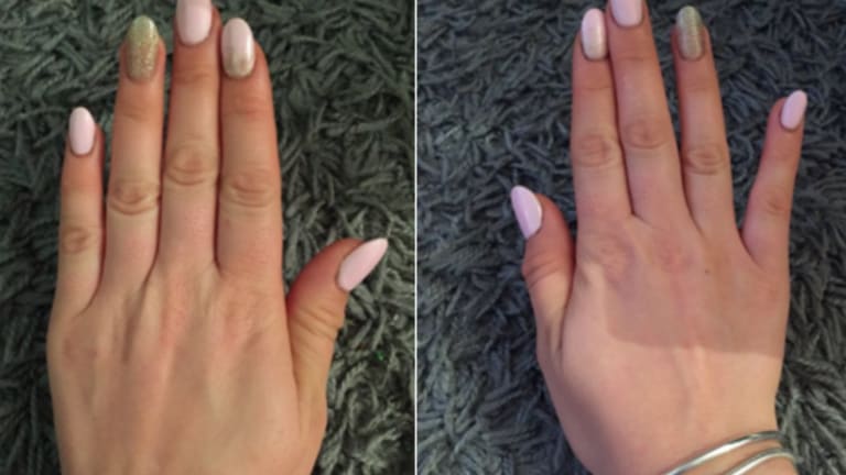 Is 'smartphone pinky' real? Probably not, but phones can still cause damage