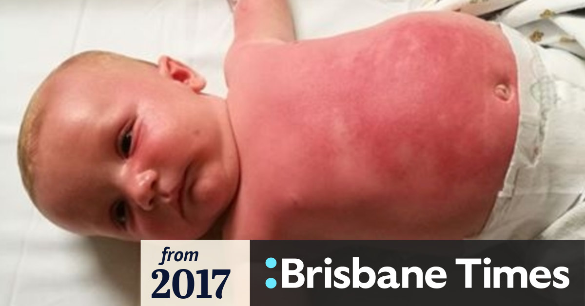 Peppa Pig sunscreen safe for most people: AMA