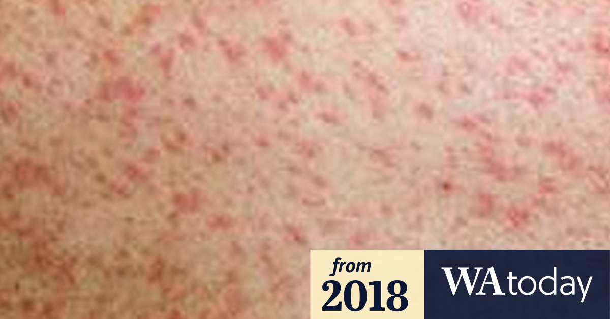 Measles alert for Perth