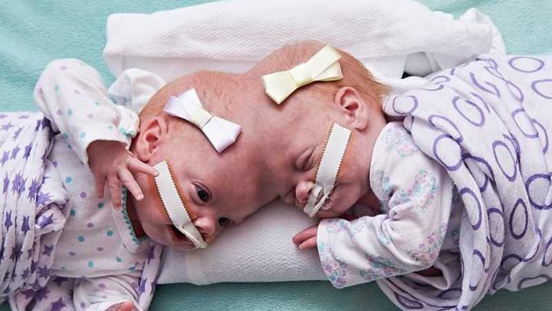 Doctors just separated twin girls joined at the head in one of the ...
