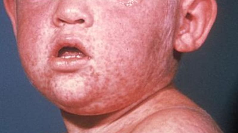 Measles alert: four people with measles have been in planes, surgeries ...
