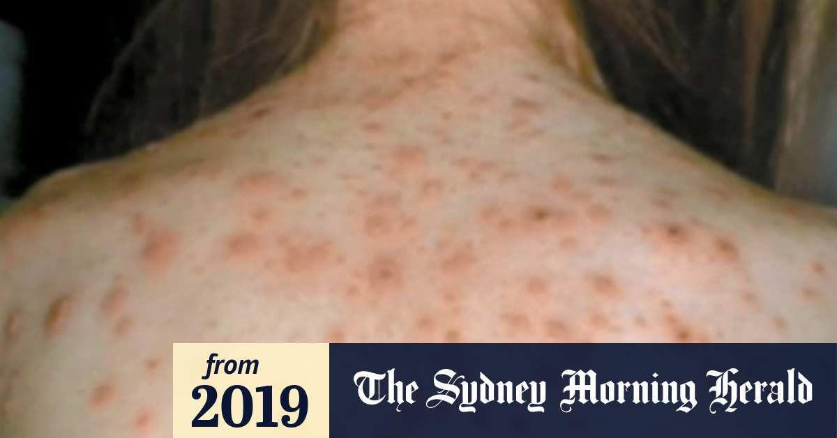 Second measles alert issued as Sydneysiders warned to look out for symptoms