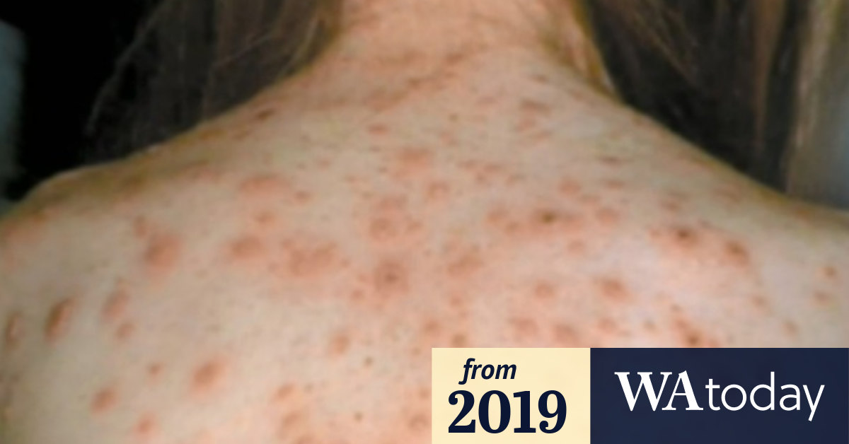 Measles alert issued for Perth cafes, childcare centres, shopping mall