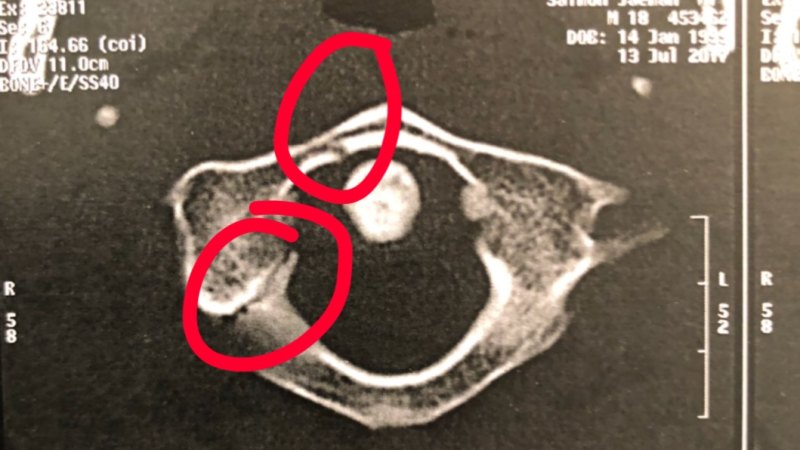 How Parramatta debutant cheated death with broken neck