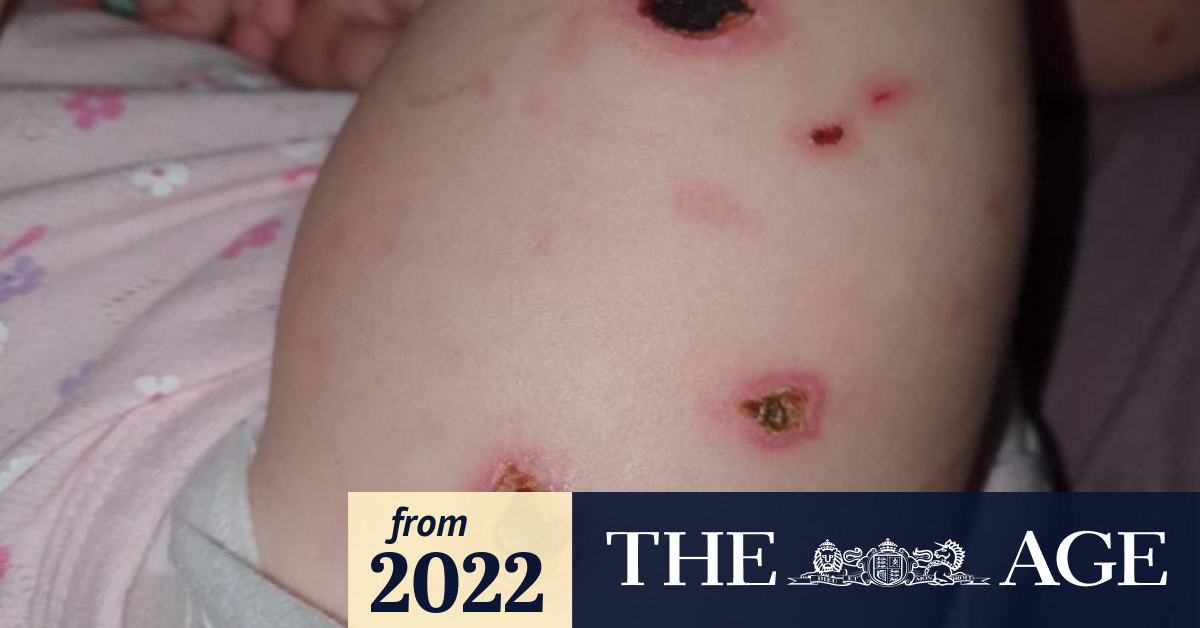 Victorian 18-year-old infected with meningococcal at schoolies