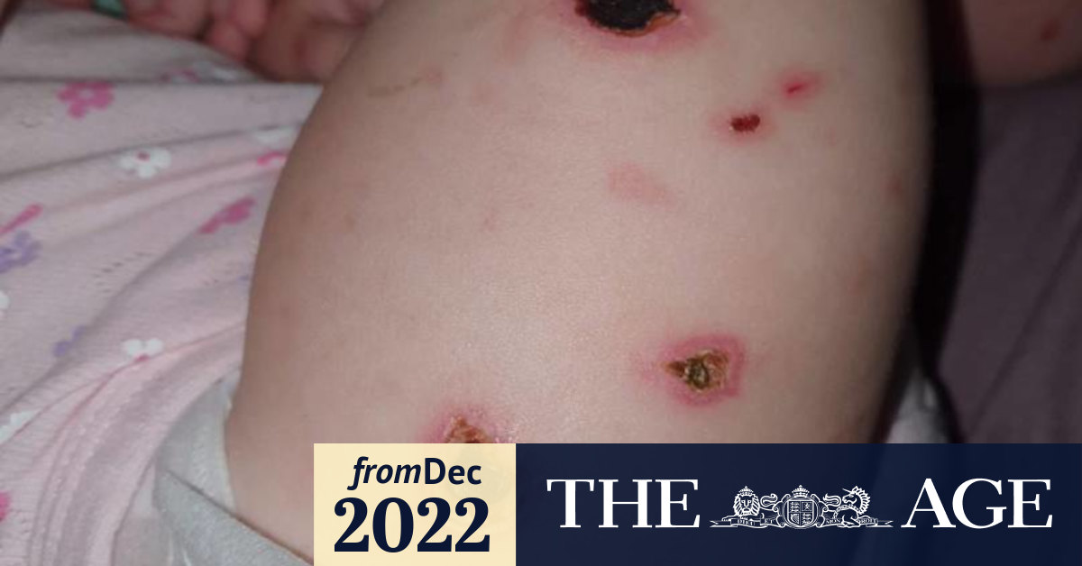 Victorian 18-year-old infected with meningococcal at schoolies