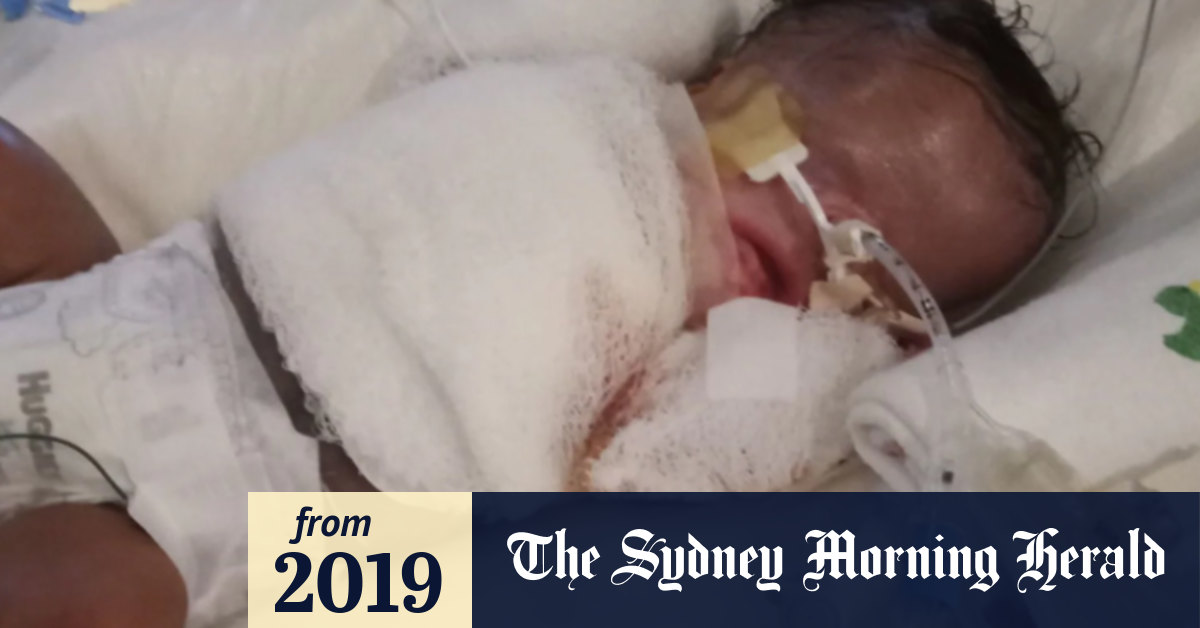 A baby was born with nearly no skin. Doctors are fighting to keep him alive