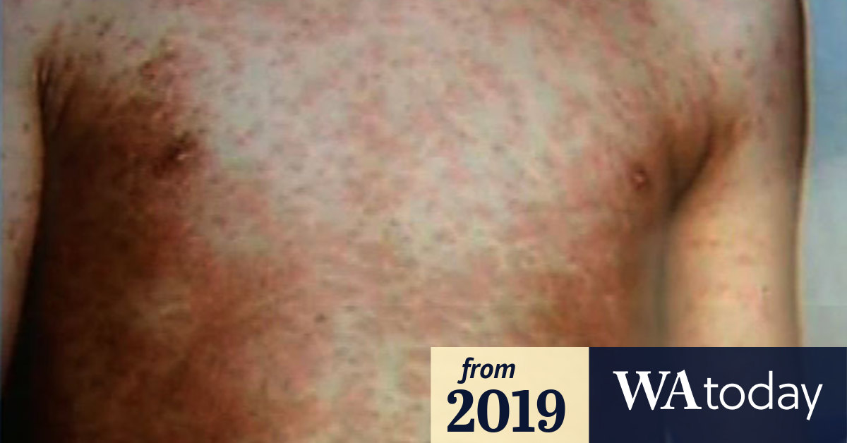 Measles warning WA: Second alert in a month for measles in Busselton