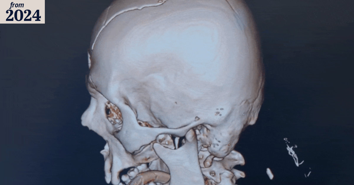 Scanning the dead: The machine replacing autopsies