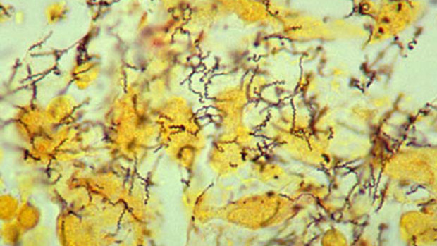 Women told to get tested after syphilis spike sees baby die in womb