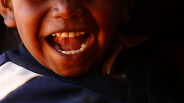 Queensland Indigenous community dental treatments reduce tooth decay in ...