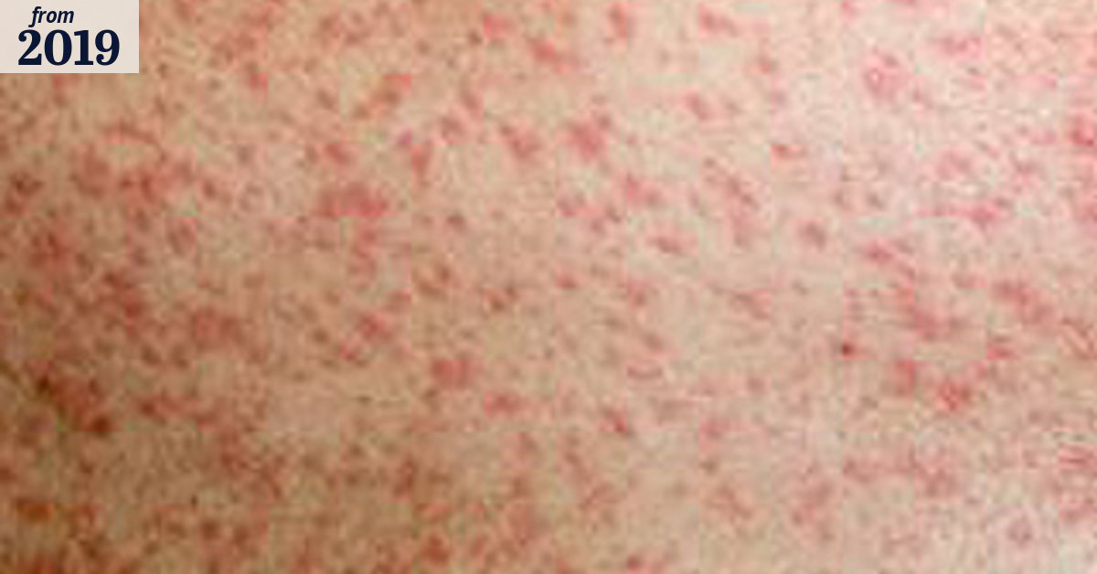 Measles alert issued for Perth universities, public transport routes
