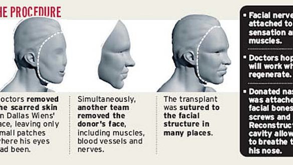 US patient thanks donor's family for full-face transplant