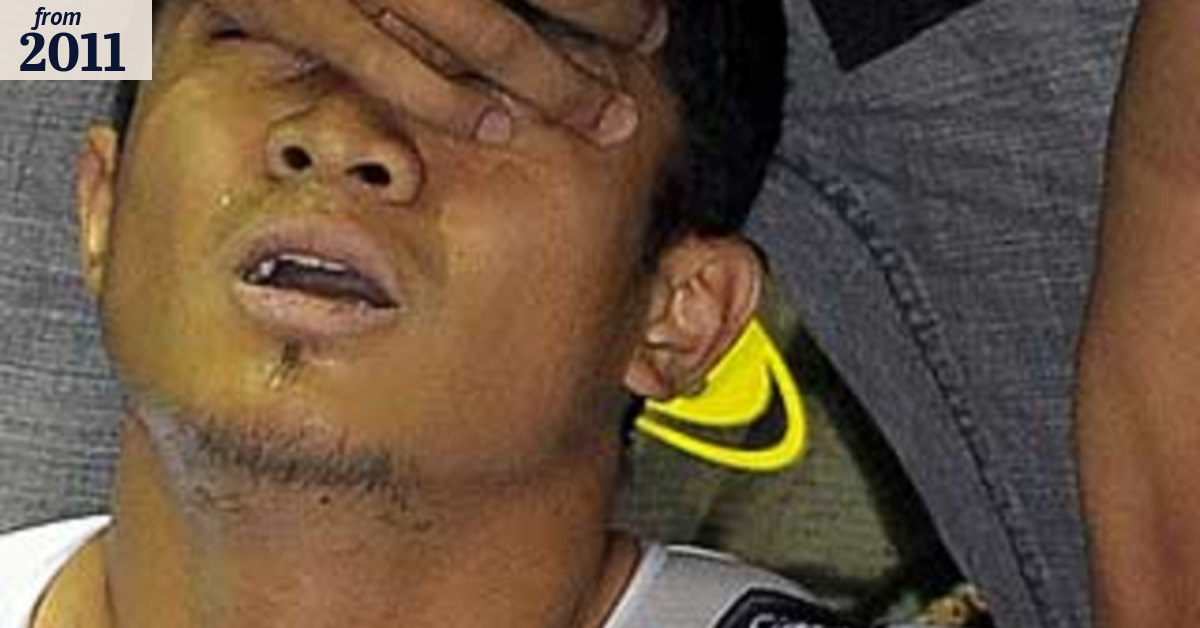 Malaysia cyclist has giant splinter removed from leg