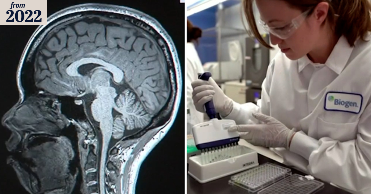 New drug slows Alzheimer's disease, but doctors are divided over it